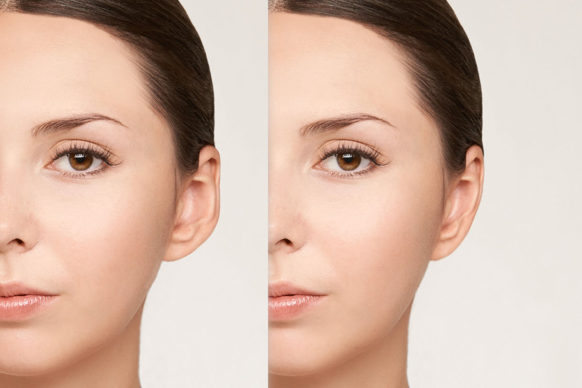 Ohrenkorrektur: Abstehende Ohren behandeln | Winterthur, Zürich