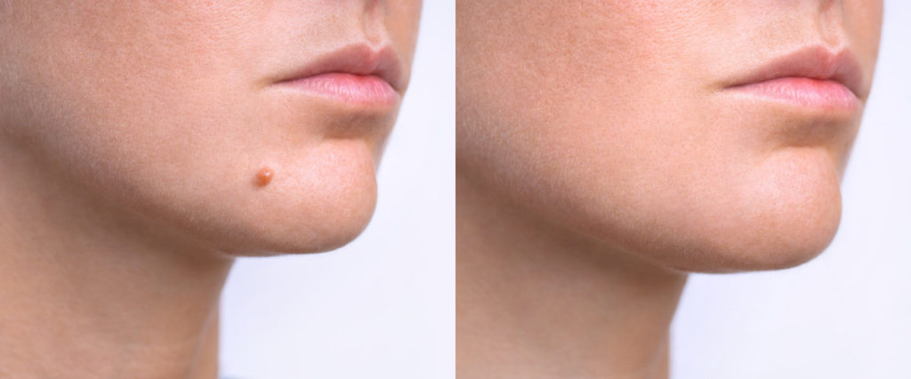 Muttermal entfernen in Winterthur, Zürich | Clinic Plastica