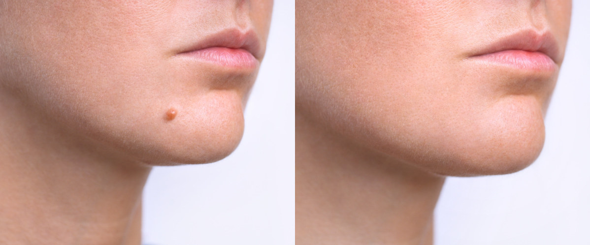 Muttermal entfernen in Winterthur, Zürich | Clinic Plastica