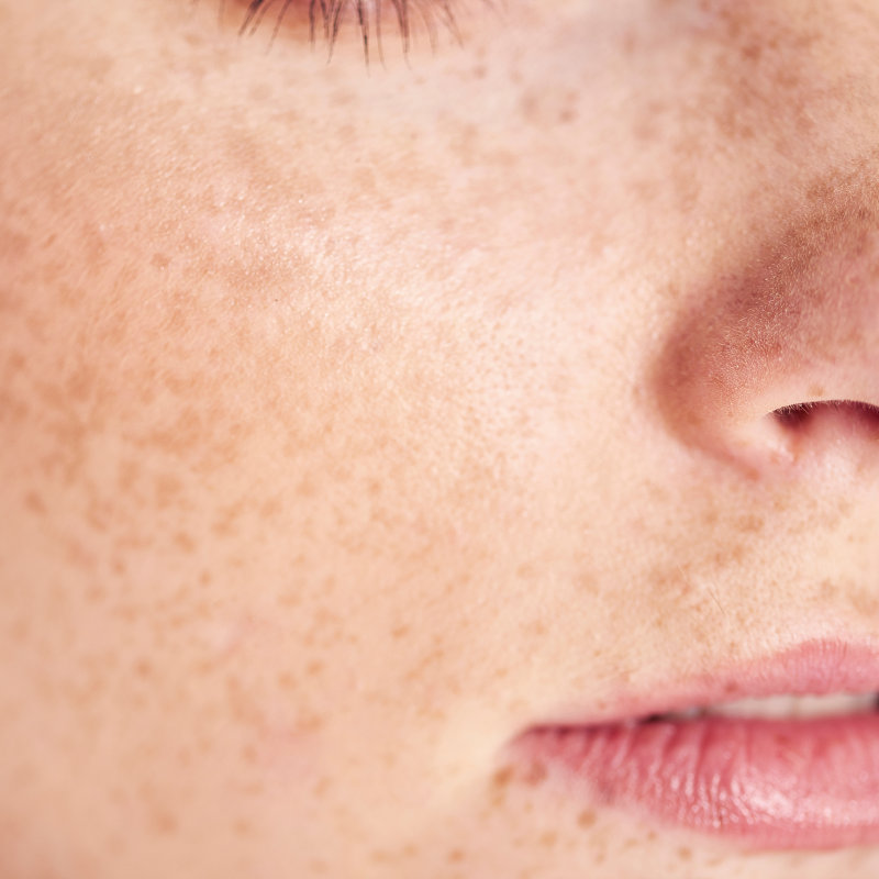 Bleichcreme Pigmentflecken Entfernen – GZVZU