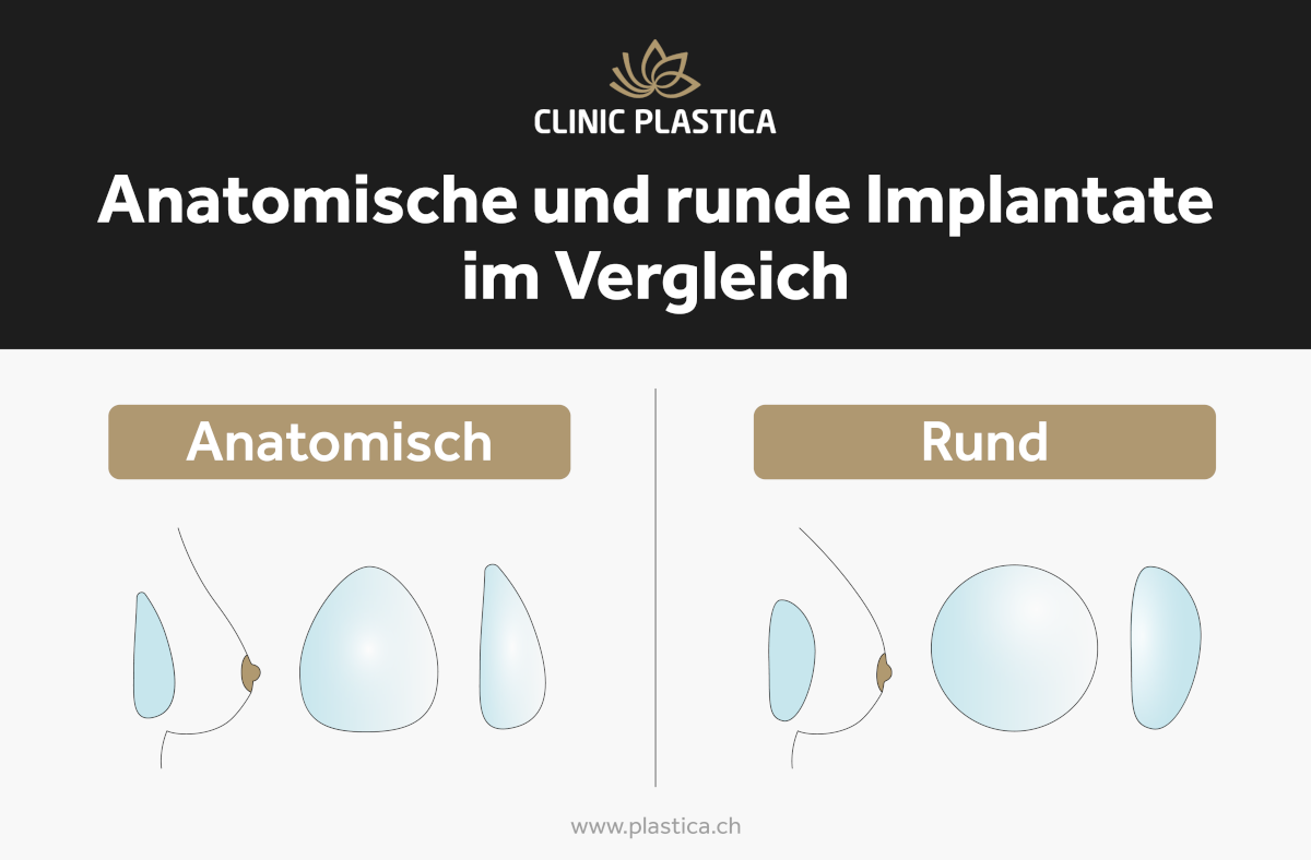 Brustimplantate: Arten, Eingriff und Risiken